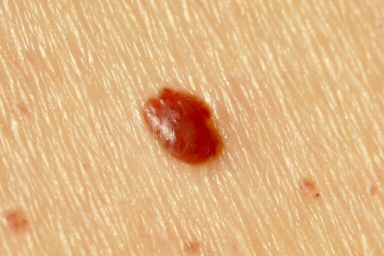 Minor Skin Surgery in Kitchener-Waterloo, ON | SpaSurgica