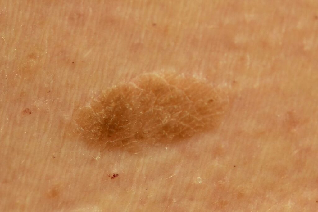 Minor Skin Surgery in Kitchener-Waterloo, ON | SpaSurgica